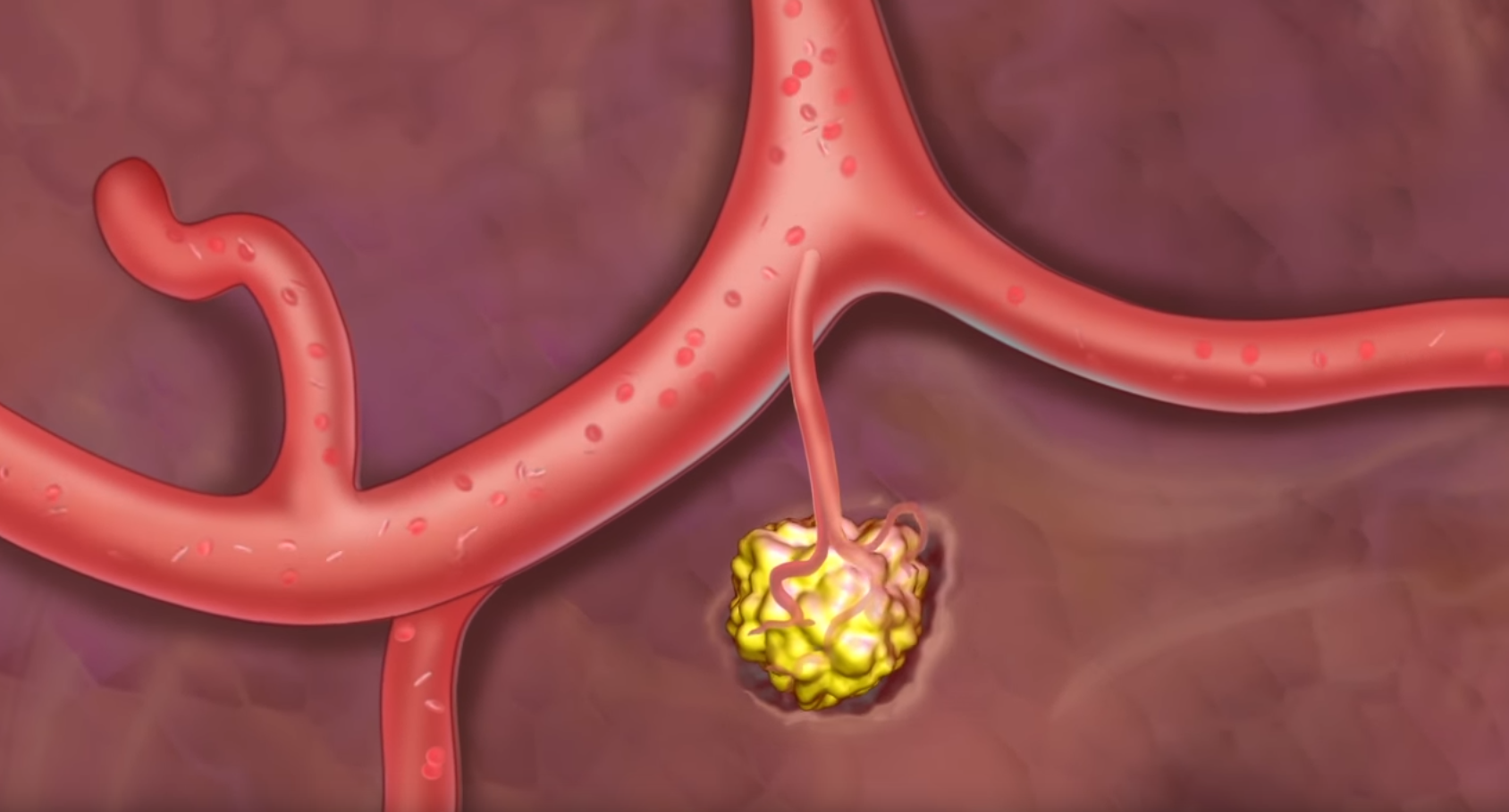 MBQ Pharma, Inc. – Metastasis – Blocking Cancer Therapies